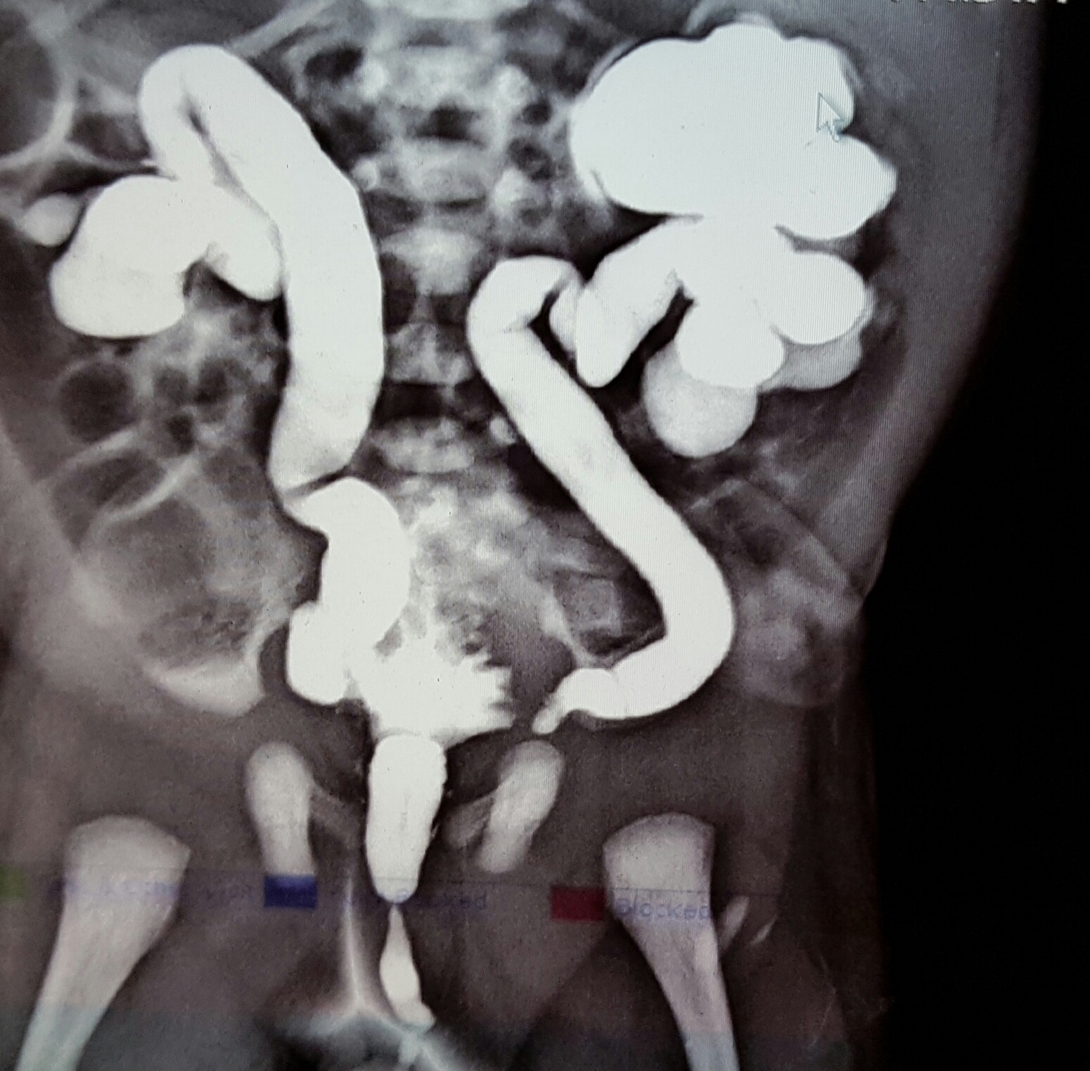 Identify posterior urethral valves early | Dr. Sidharth Kumar Sethi